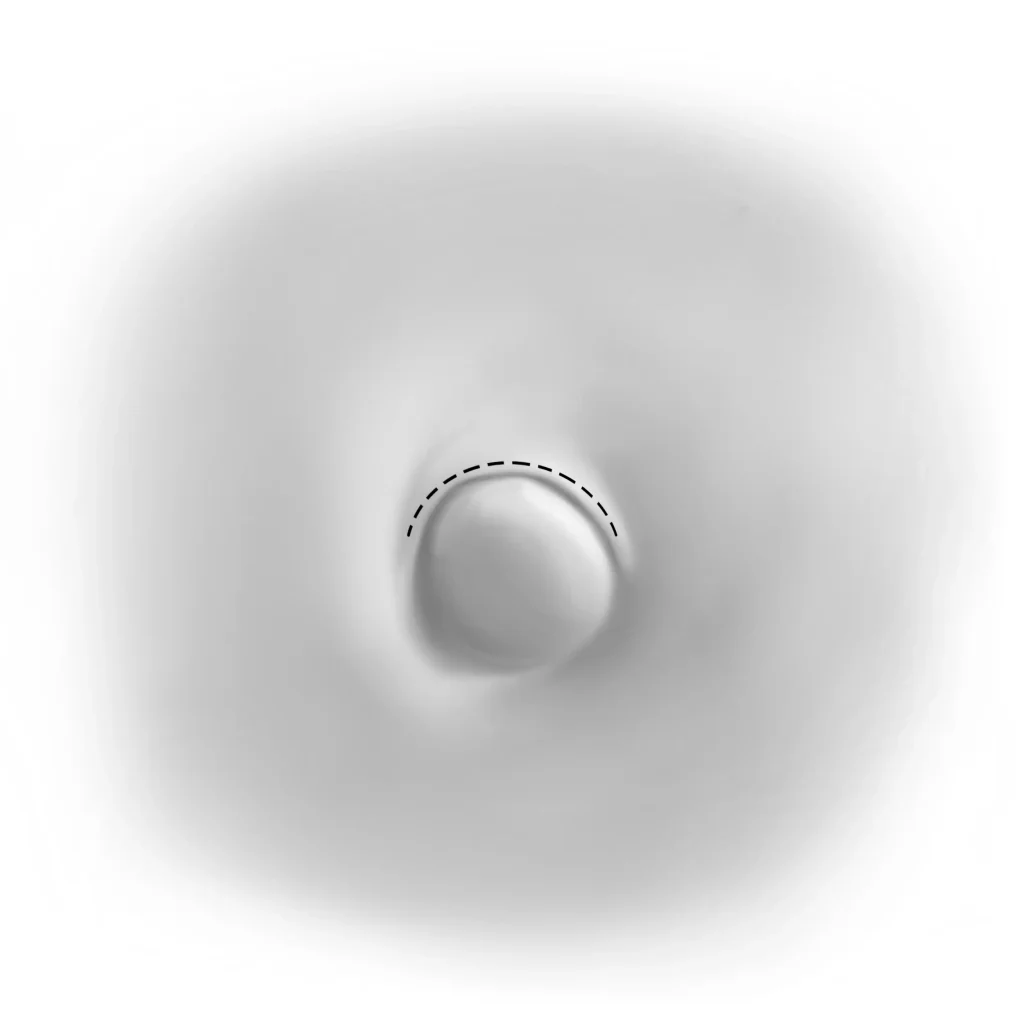 The Mayo repair technique explained | BioHernia