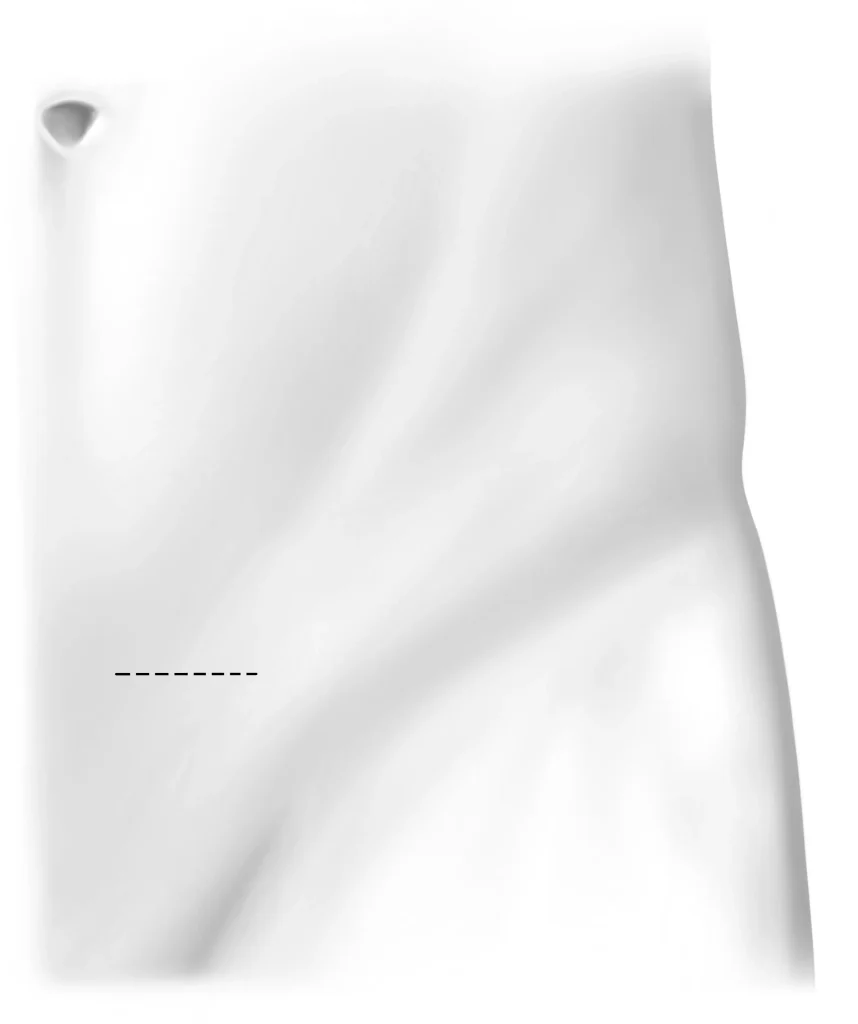 Inguinal hernia mesh removal illustrated | BioHernia